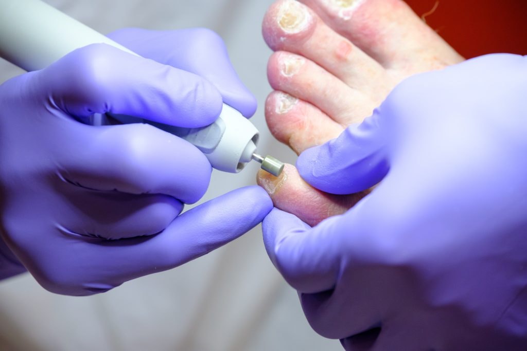 Fungal Nail Treatment Oxfordshire - Precious Feet Footcare